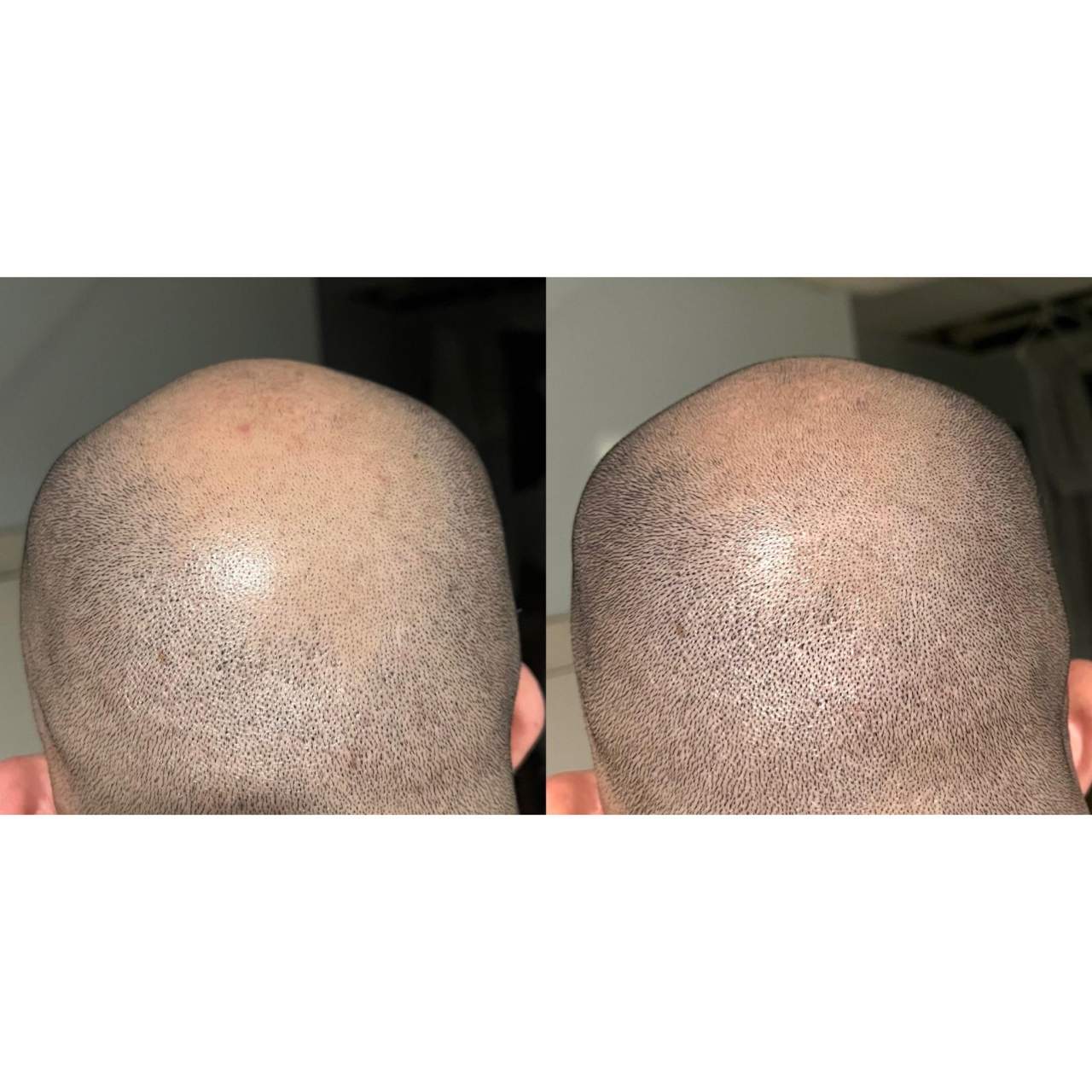 RU58841 5% en México