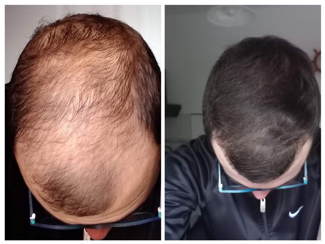 Dutasteride tópico 0.1% en México