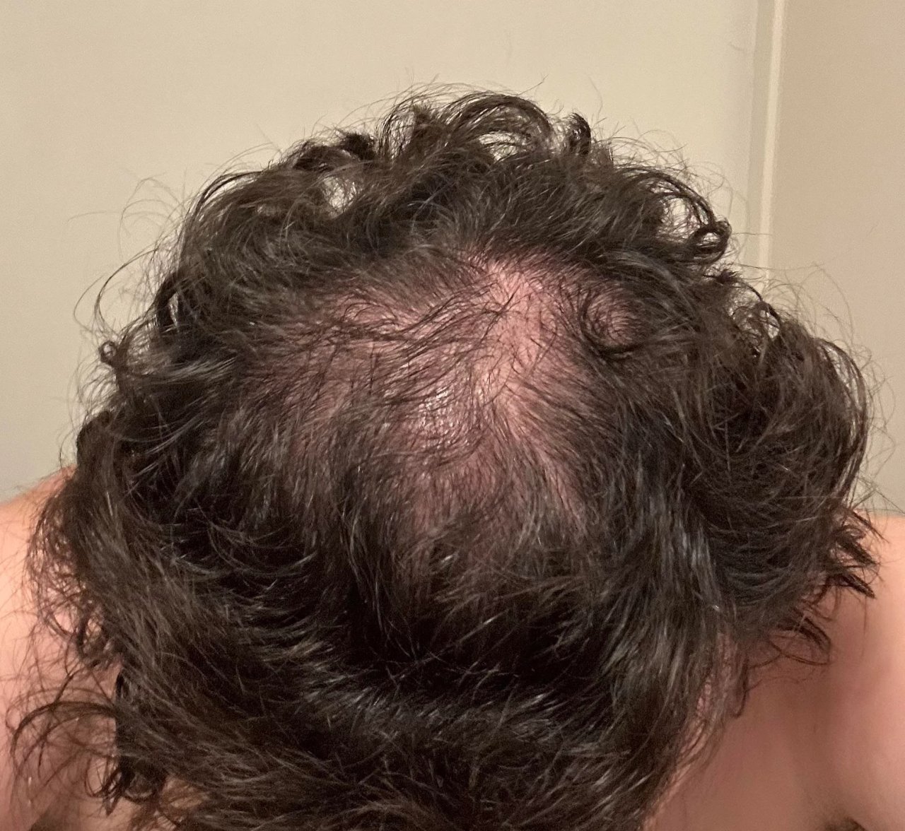 RU58841 5% en México